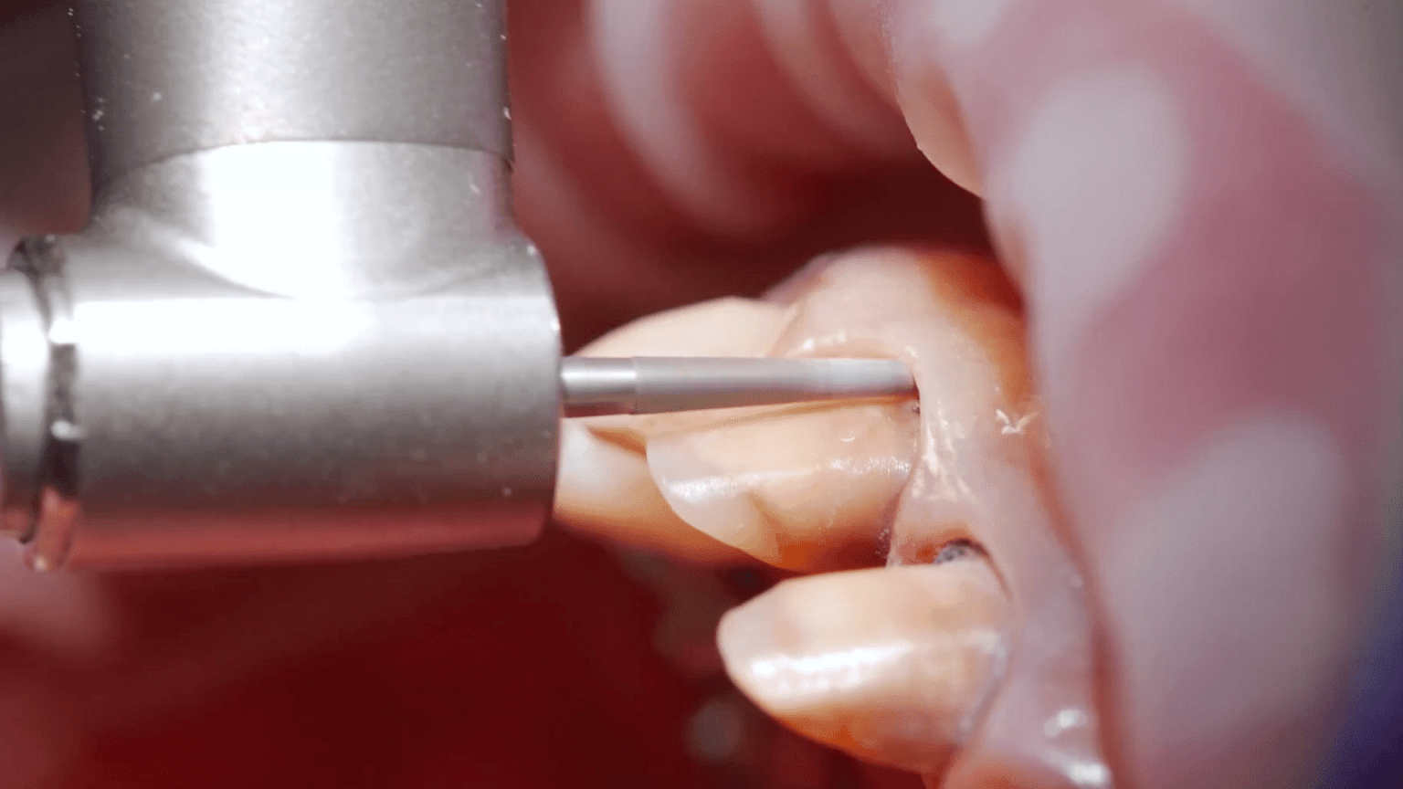 Veneer Prep Design: Comprehensive Guide for Dentists