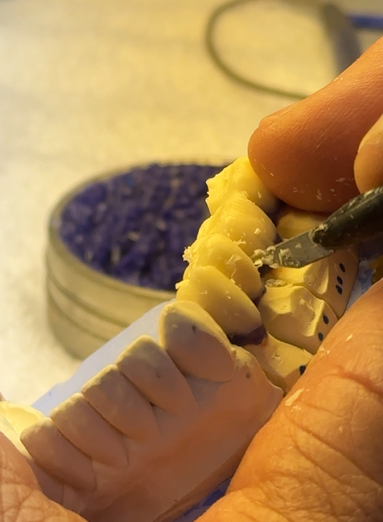 Mastering Emax Restorations: Essential Tips for Success