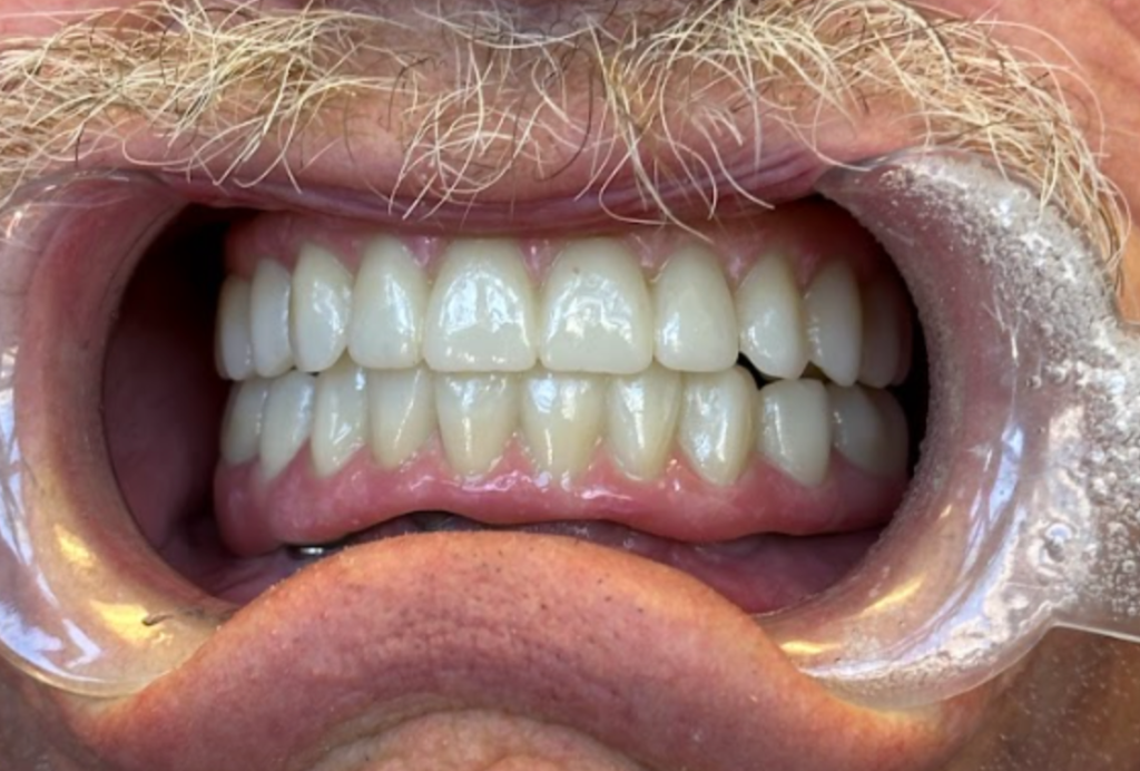 Implant-Supported Hybrid Prosthesis for An Dementia Patient